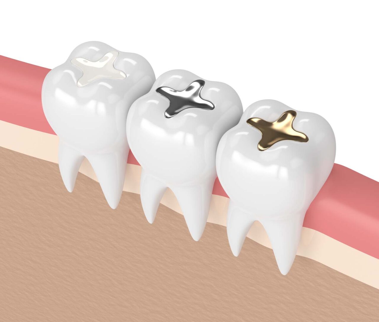 Dental Restorations - Wainwright Dental Care